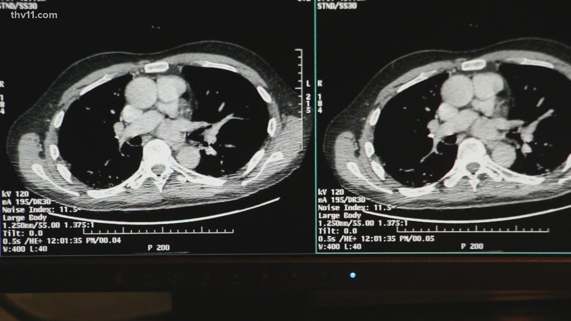 Contrast dye shortage impacting hospitals | thv11.com