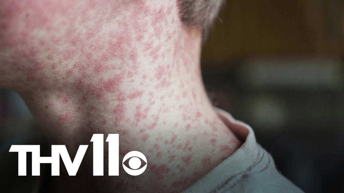 Measles prevention remains a challenge for US doctors | thv11.com
